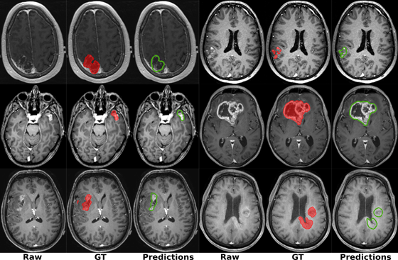 Image-guided neurosurgery - SINTEF